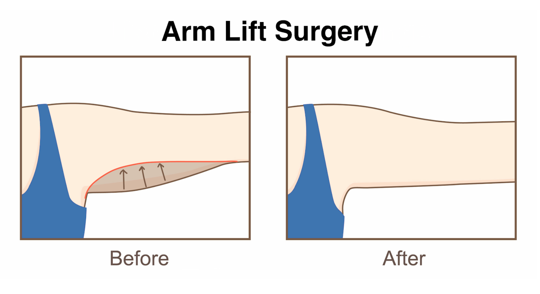 Arm Lift - BeContour
